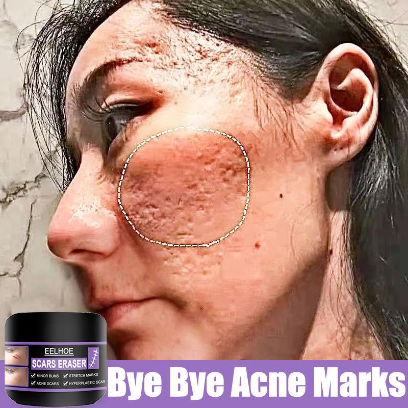 COD Scar Remover pimple marks remover acne scar remover scars - TikTok ...