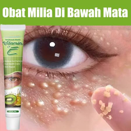 20g Milia Remover Cream Syringoma Xanthelasma Fat Granules Around ...