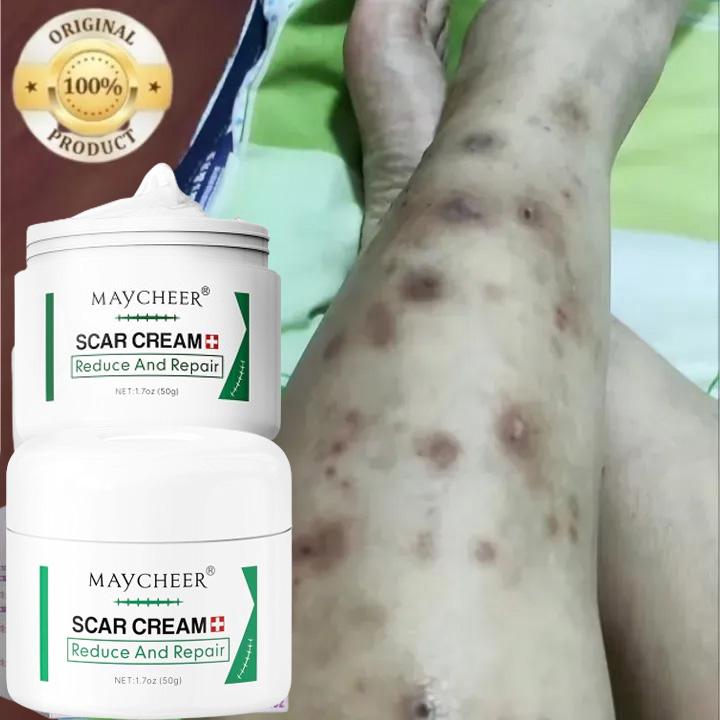 Krim Penyingkiran Parut, 100% Berkesan, Untuk Parut Lama dan - TikTok ...
