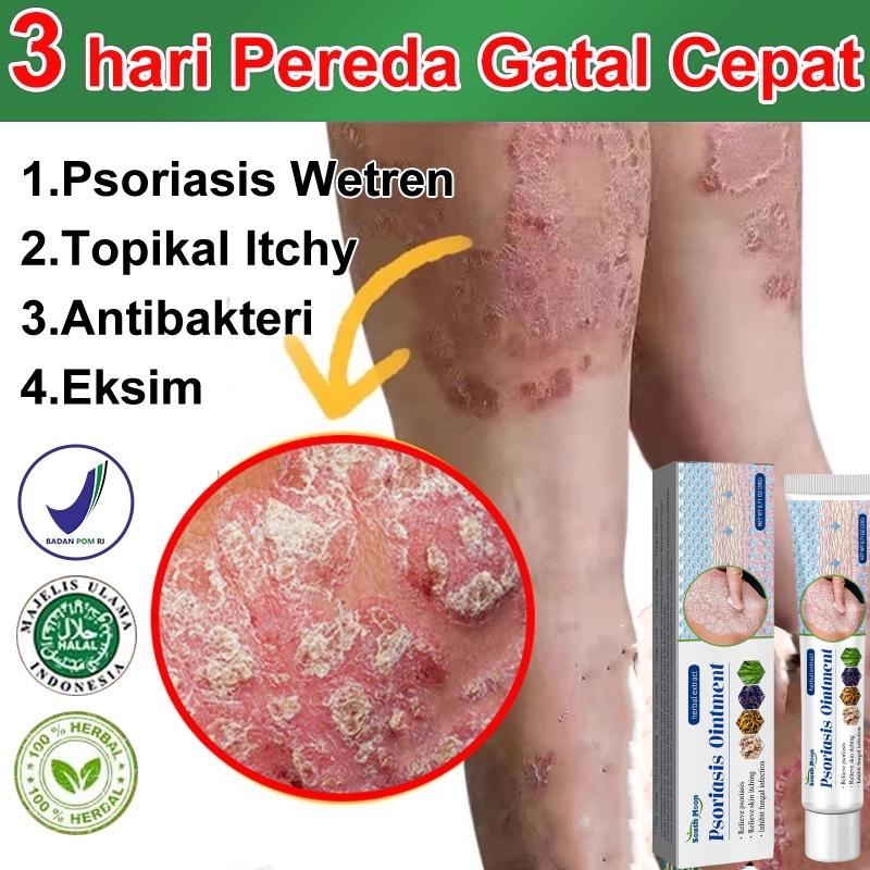 Obat Gatal Kulit Cepat - Salep Eksim - Obat Psoriasis 20G Salep Kulit ...