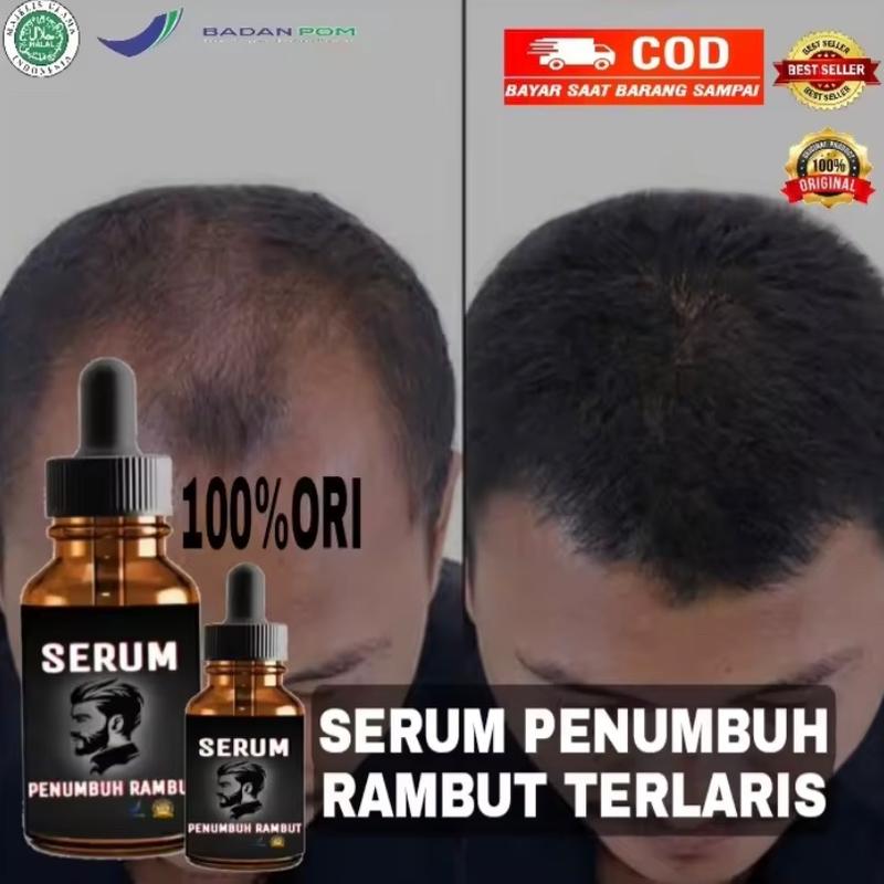 Penumbuh Rambut Secara Cepat / Obat Penumbuh Rambut Botak Super - Shop ...