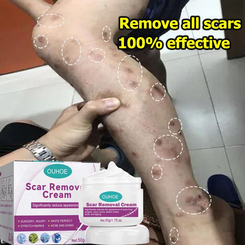 Scar Remover Cream 100% Effective Suitable For Old New Scars - TikTok ...