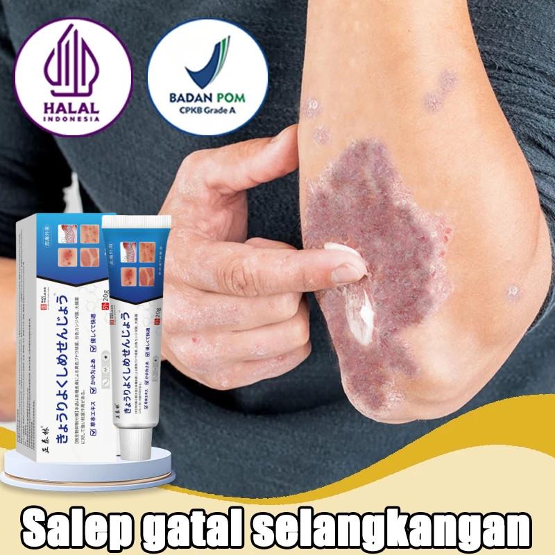 Salep gatal Salep Eksim Salep kulit Krim psoriasis paling ampuh - Shop ...