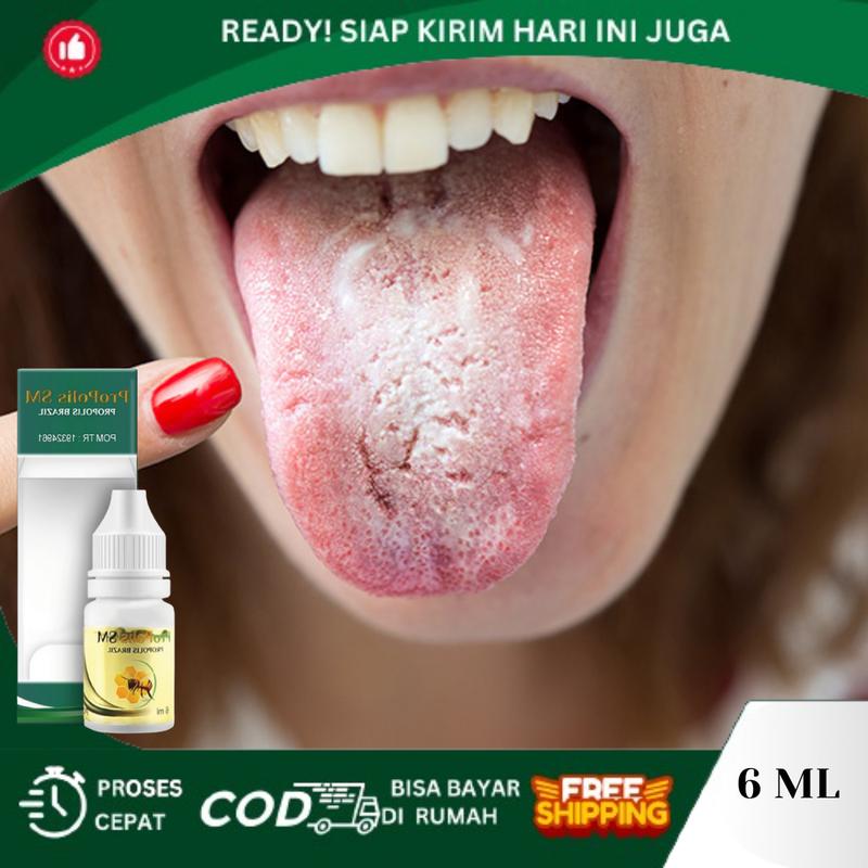 Tetes Lidah Putih, Bercak Putih Di Lidah Anak Dan Dewasa, Radang - Shop ...