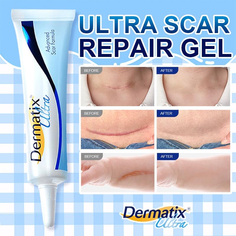 Dermatix Ultra Scar Repair Gel 15g Effectively Fades Scars Works ...