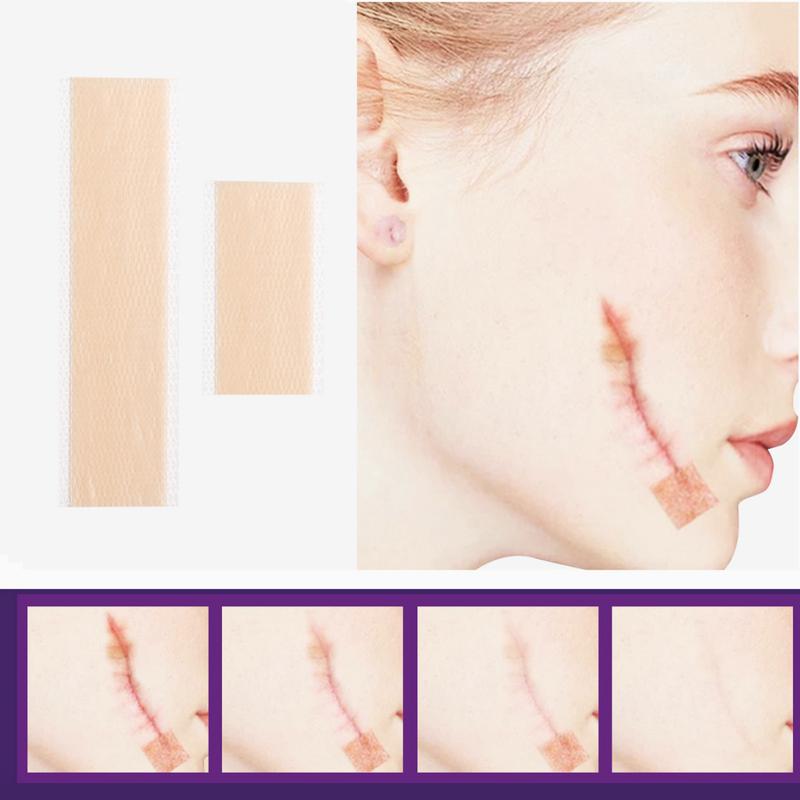 Leiing- Scar Strip Harmless Long Lasting Scar Strip Removal Scar ...