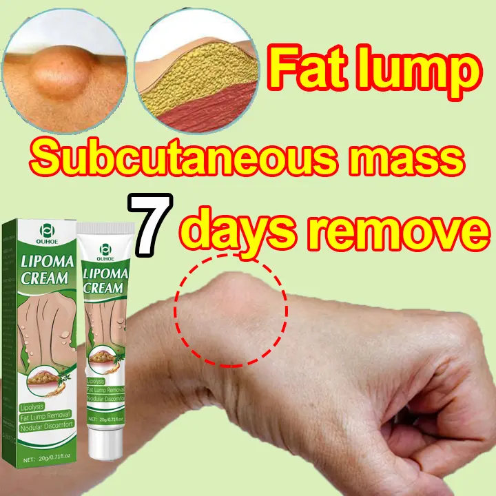 100% authentic lipoma removal cream original Japan lipoma cream ...
