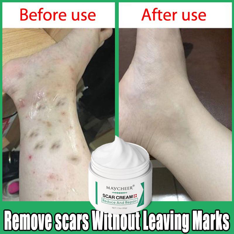 MAYCHEER Scar Remover for Old Scar On Leg Stretch Mark Remover - TikTok ...
