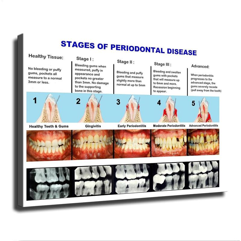 Dental Clinic Wall Poster Periodontal Disease Staging Chart Poster ...
