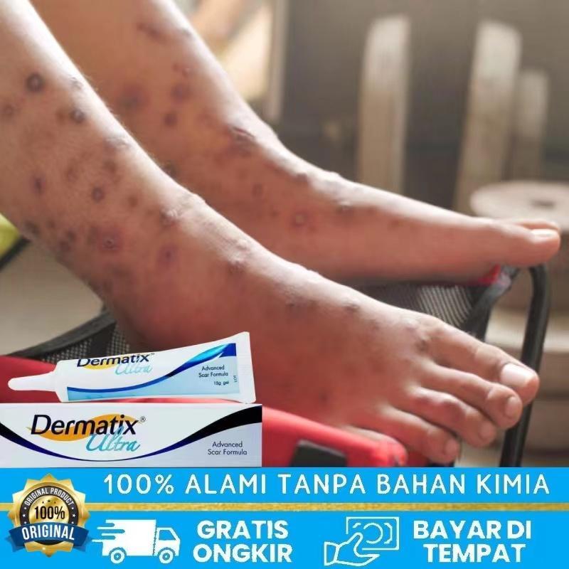 Dermatix Ultra Advanced Scar Formula Gel 15Gr / Salep Penghilang Bekas ...