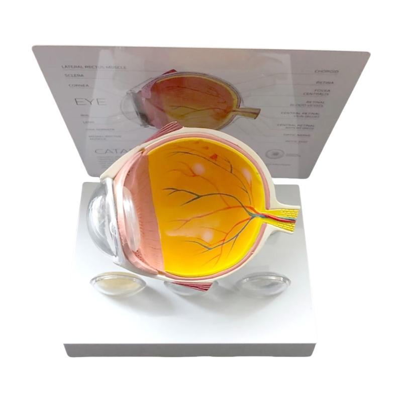 hiw6 Human Eyeball Model Realistic Pathological Eyeball Anatomy ...