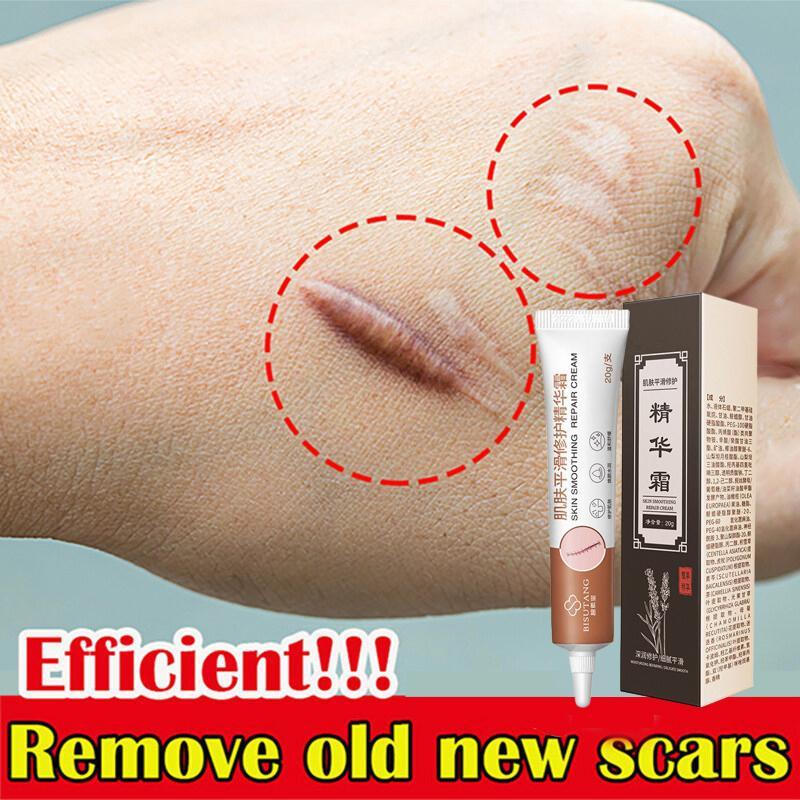 Acne Scar Removal Cream Treatment Remove Stretch Marks acne scar ...